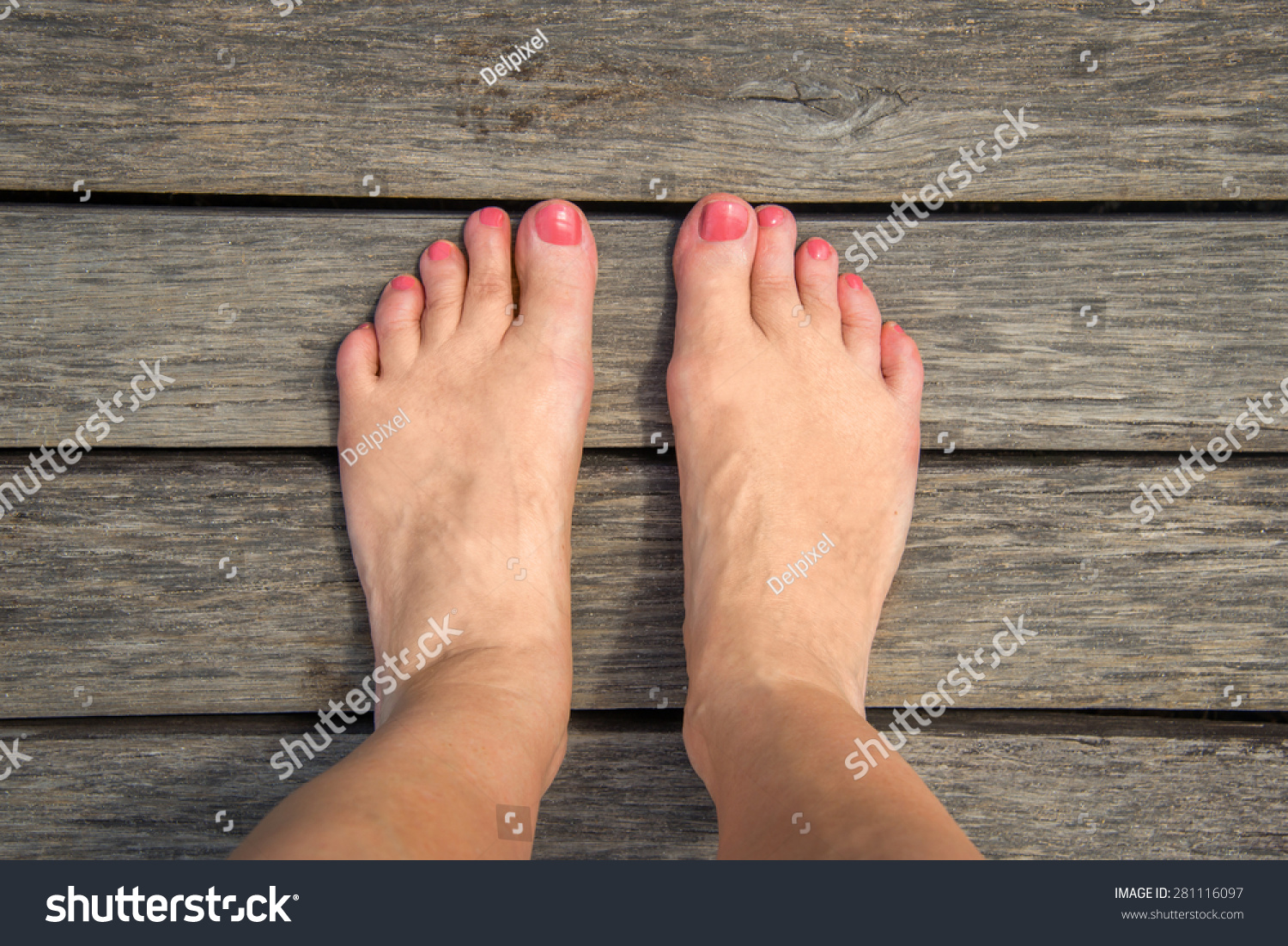 'Foot Selfies' May Improve Remote Diabetic Foot Monitoring