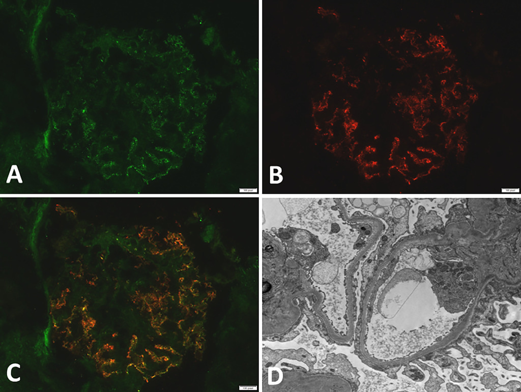 Renal adverse effects Diffuse Podocytopathy Semaglutide obse